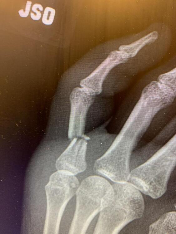 Ouch.. angulated finger fracture. Ortho nerds.. thoughts on recovery? X ...