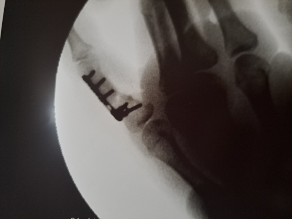 Ouch.. angulated finger fracture. Ortho nerds.. thoughts on recovery? X ...