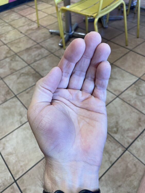 Hyper extended thumb breaking two falls. Bruised muscle in palm of hand