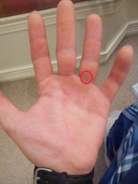 A2 injury WHILE open handed